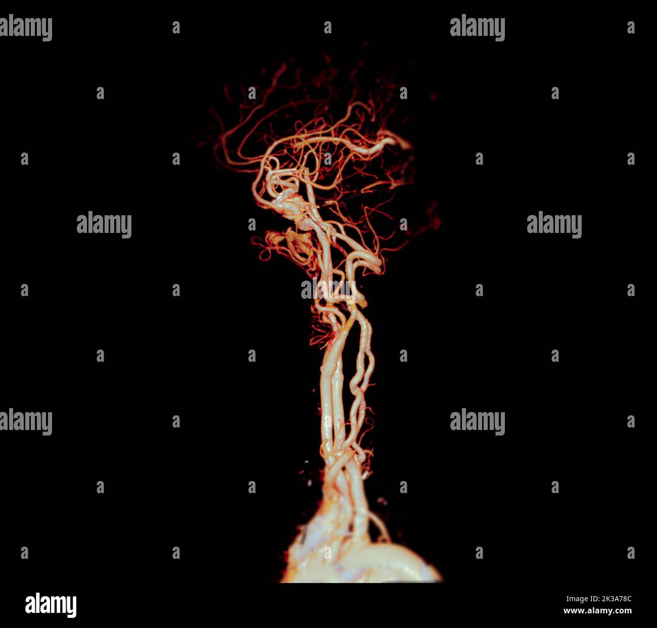 CTA brain or CT angiography of the brain 3D Rendering image for ...