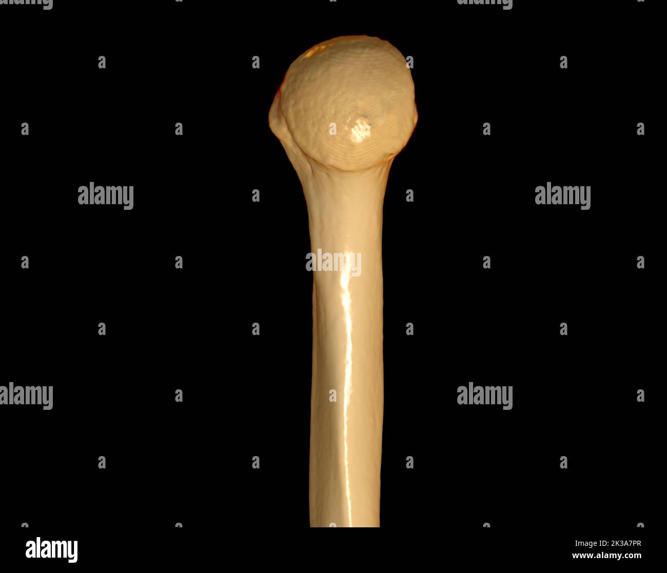 CT scan of head of humerus 3D of Computed Tomography Volume Rendering ...