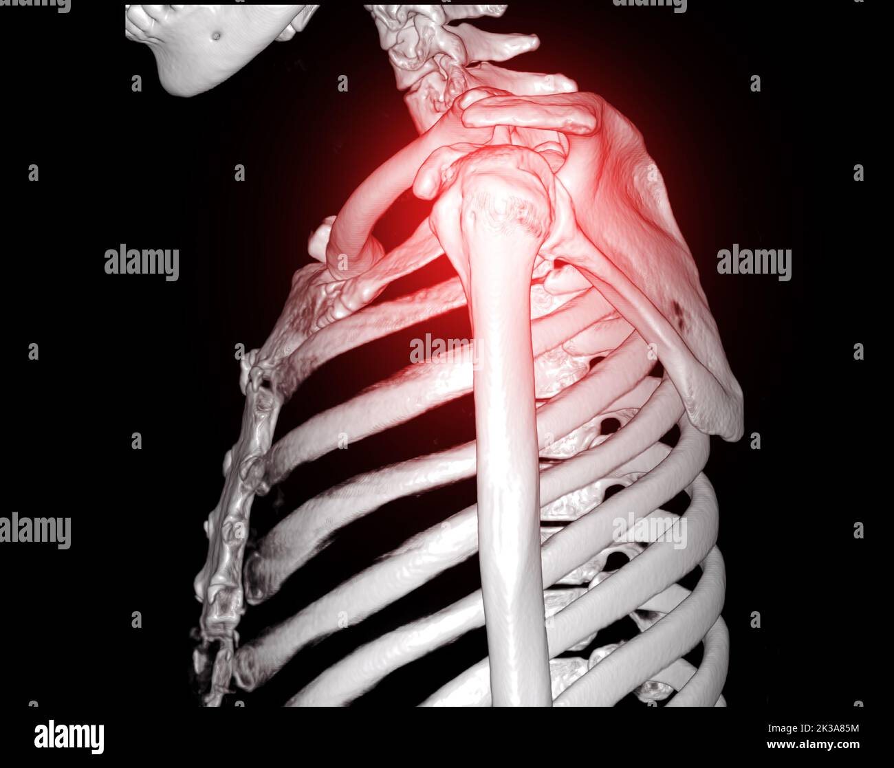 CT Shoulder 3D of Computed Tomography Volume Rendering examination of ...