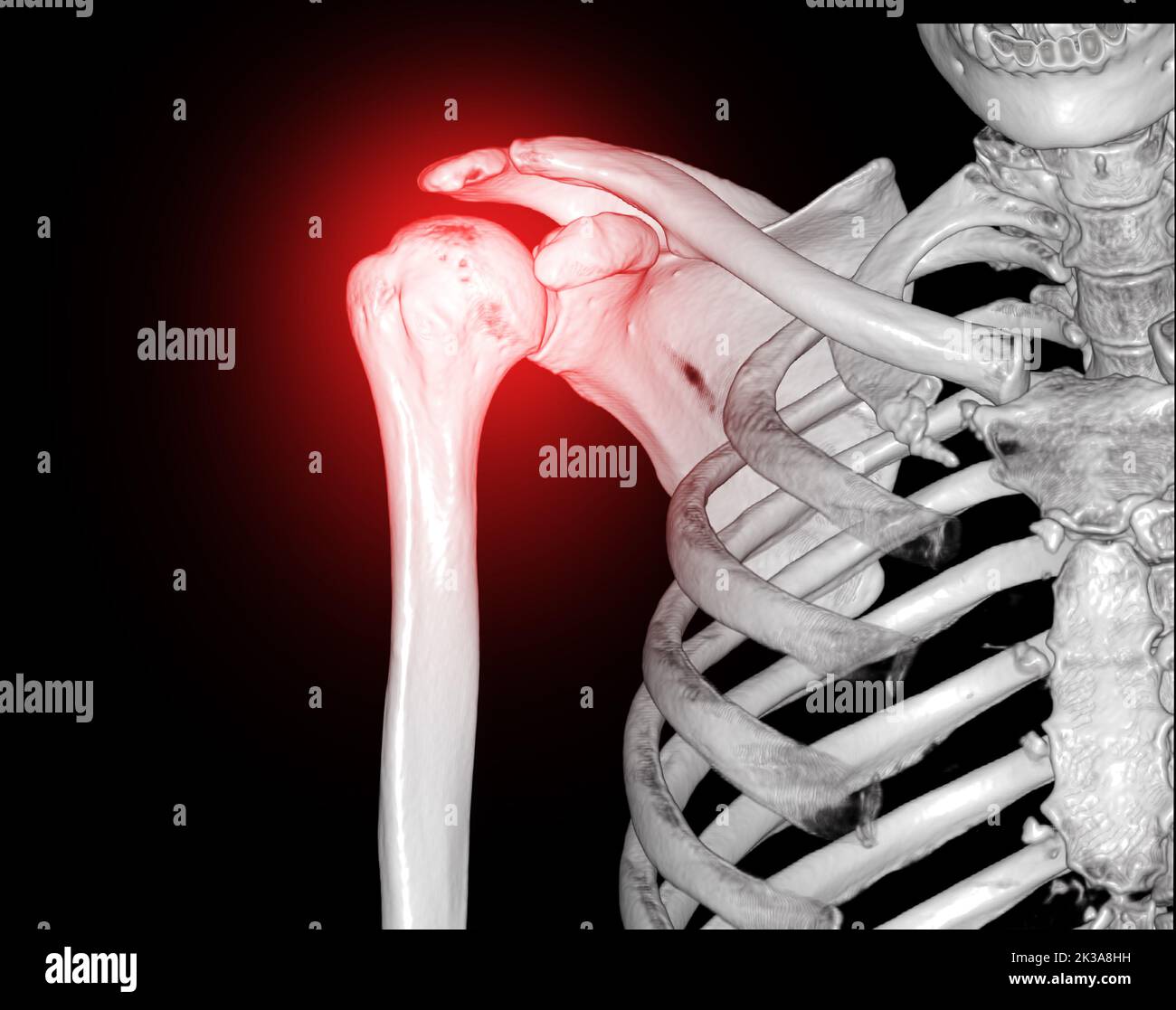 CT Shoulder 3D of Computed Tomography Volume Rendering examination of ... CT Shoulder 3D of Computed Tomography Volume Rendering examination of ...