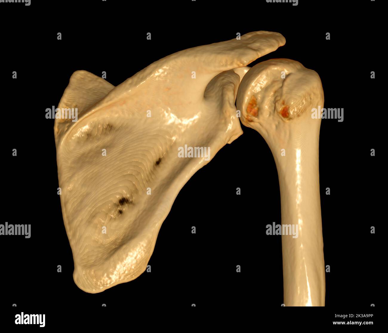 CT Shoulder 3D of Computed Tomography Volume Rendering examination of ...