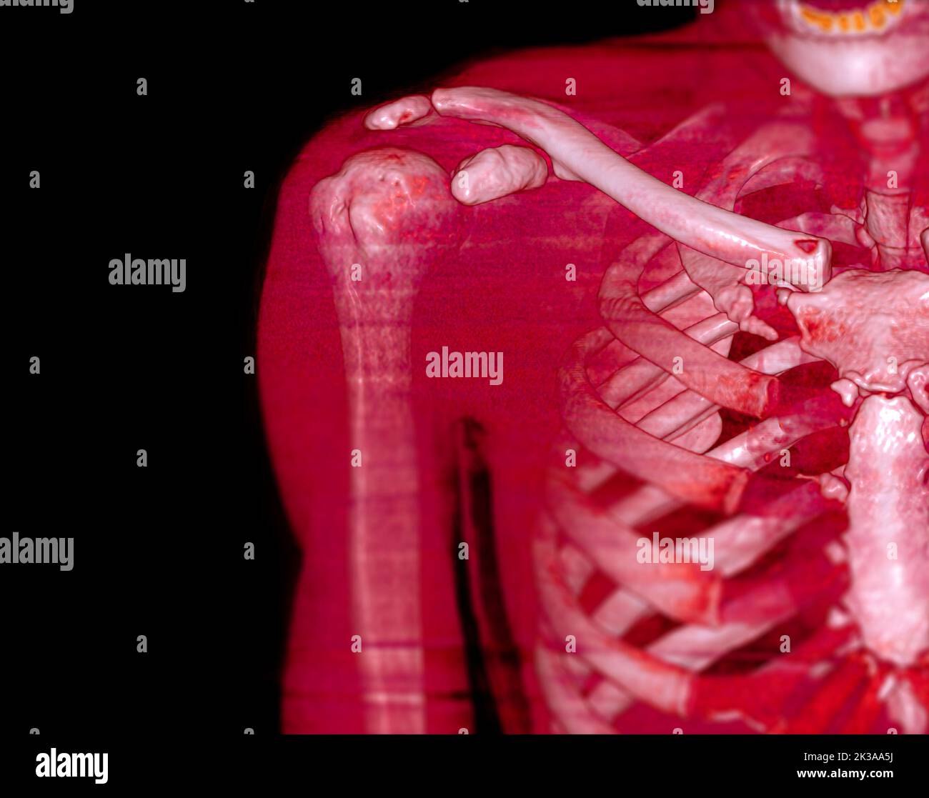 Computed Tomography Volume Rendering examination of the Shoulder 3D ...
