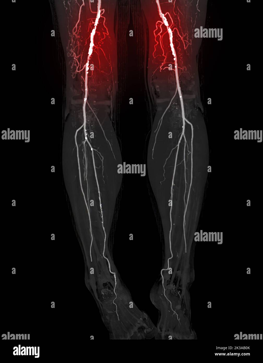 CTA femoral artery run off image of femoral artery Presenting with ...