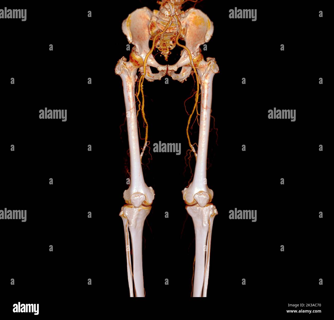 CTA femoral artery run off 3D rendering image of femoral artery ...