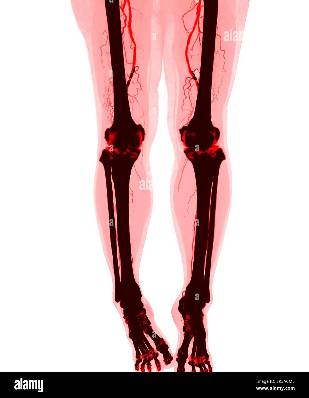 CTA femoral artery run off image of femoral artery Presenting with ...