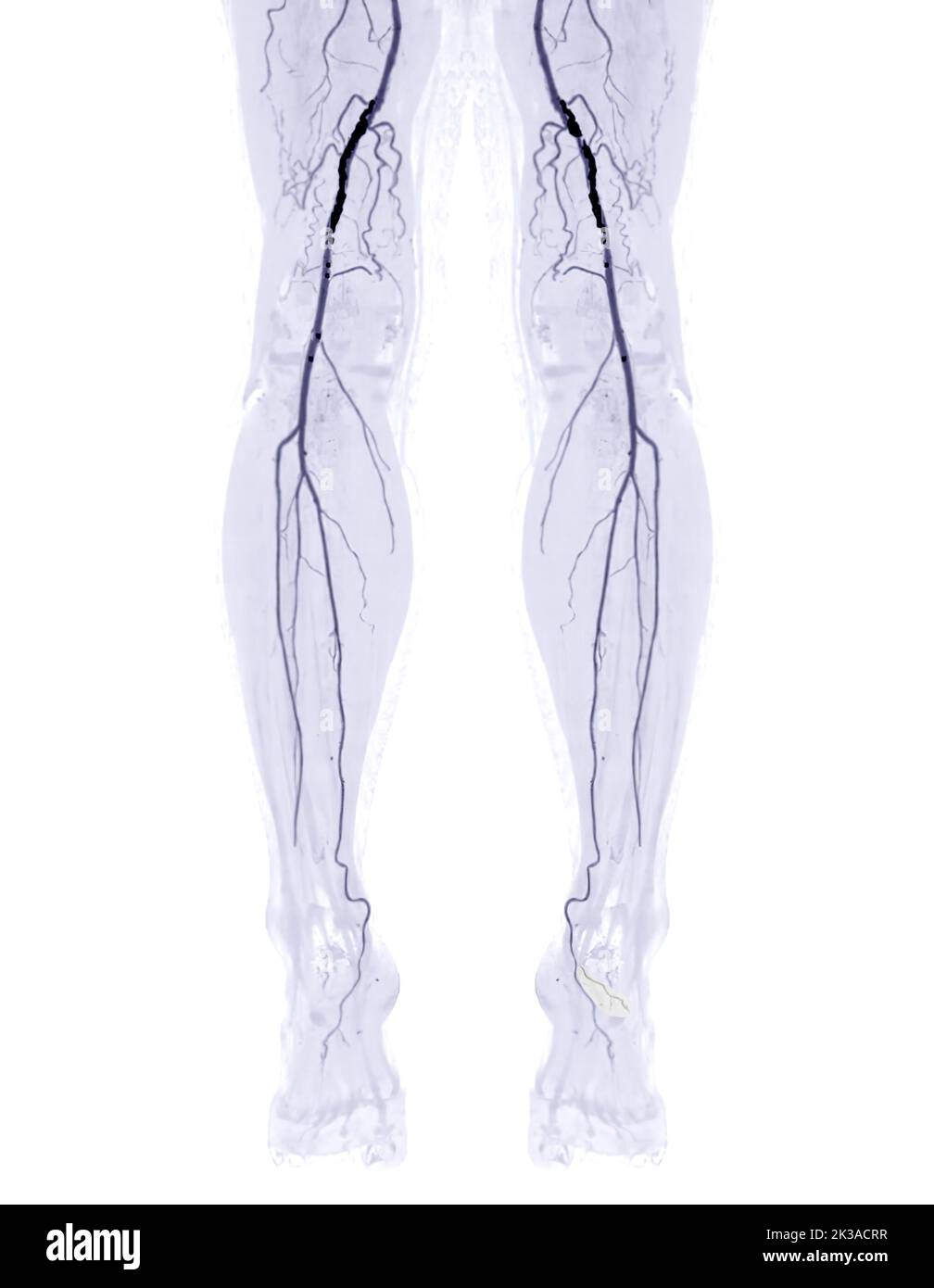 Cta femoral artery hi-res stock photography and images - Alamy