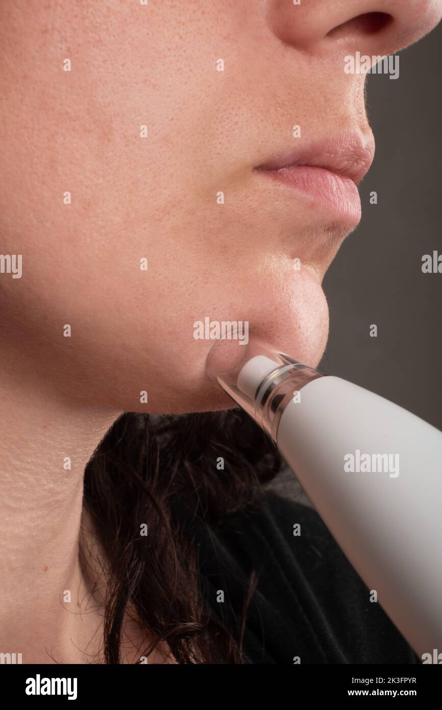 woman with vacuum face pore cleaner, skin care Stock Photo - Alamy