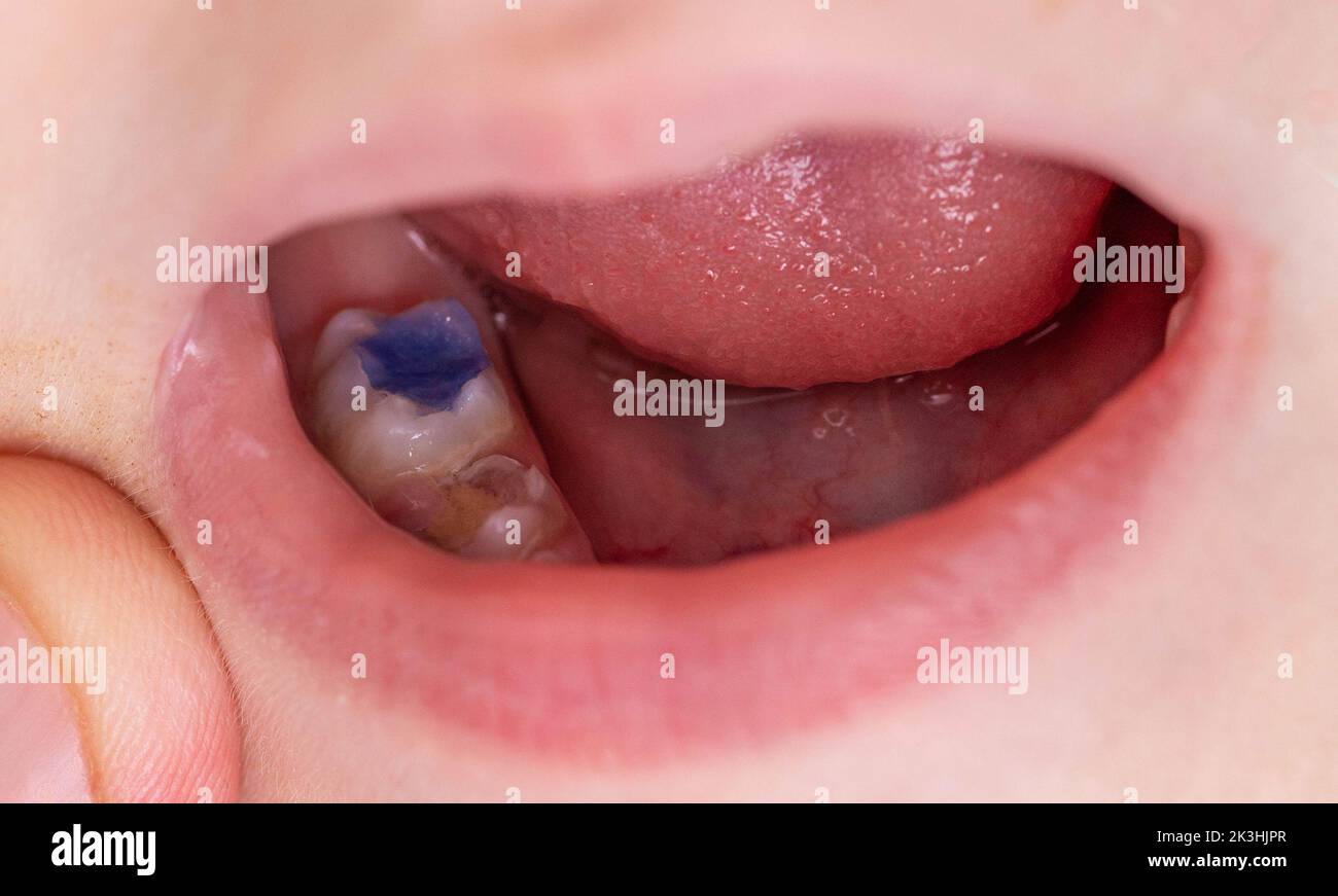 Colored blue filling in a child's tooth after caries treatment. Modern ...