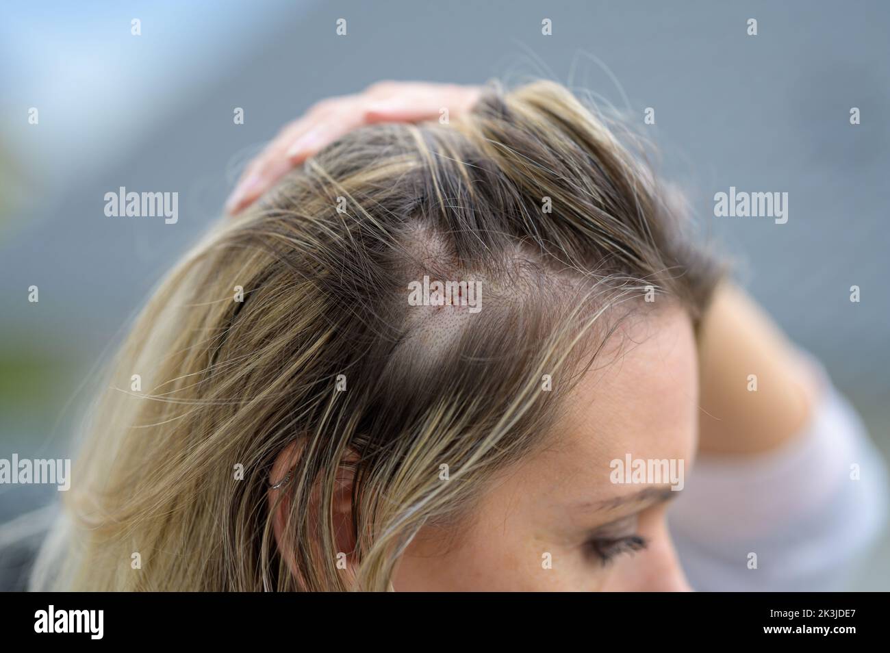 A close-up of the head and eye of a blond woman with a recent surgery ...