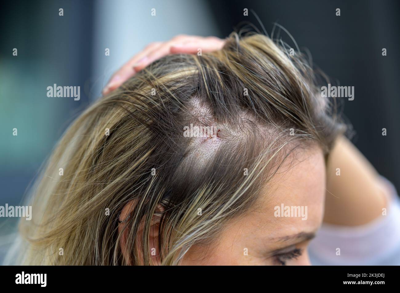A blonde woman's head in a closeup with a recent surgery scar holding ...