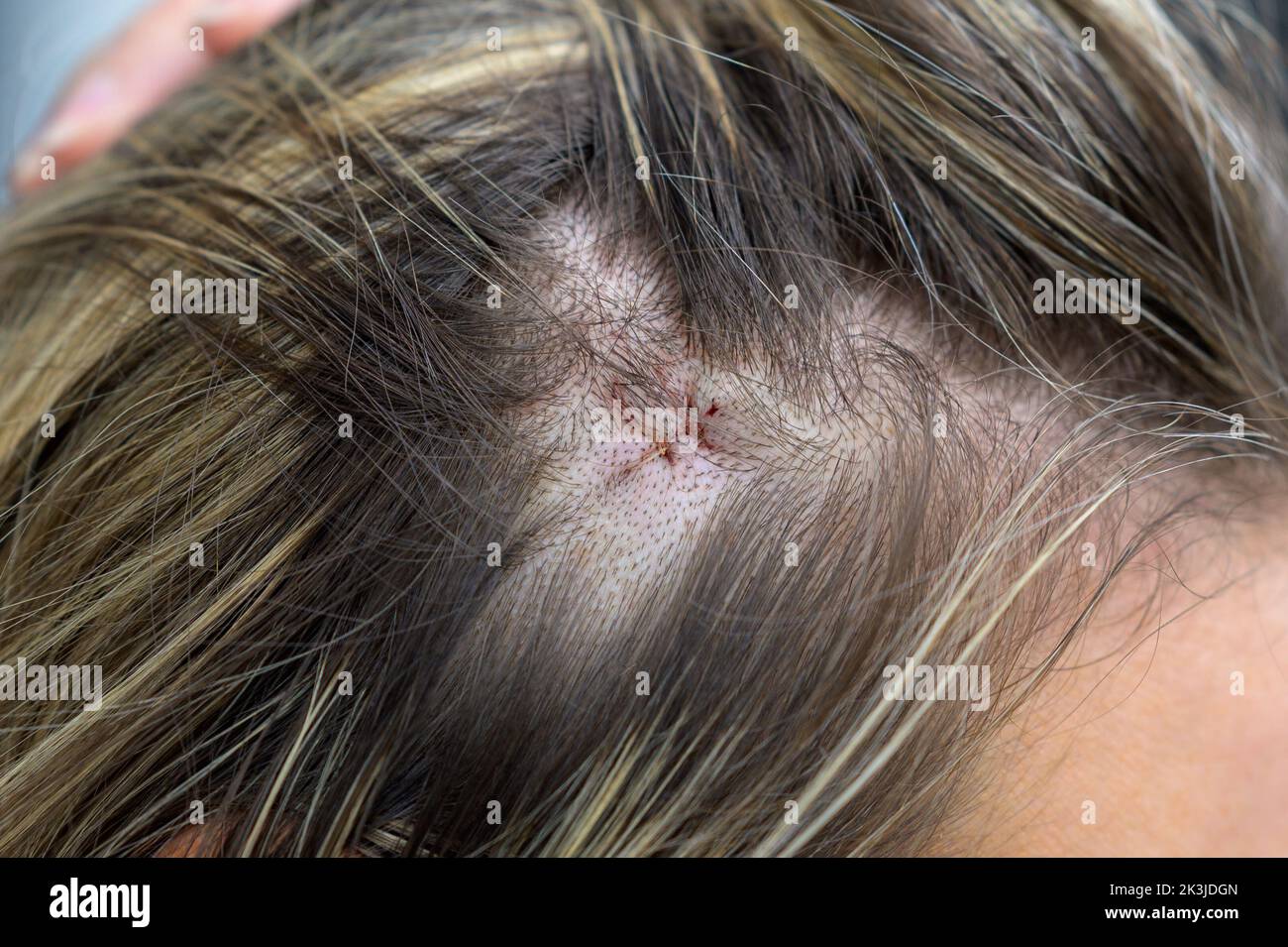 Close up cropped of a blonde woman's head with a recent surgery scar ...