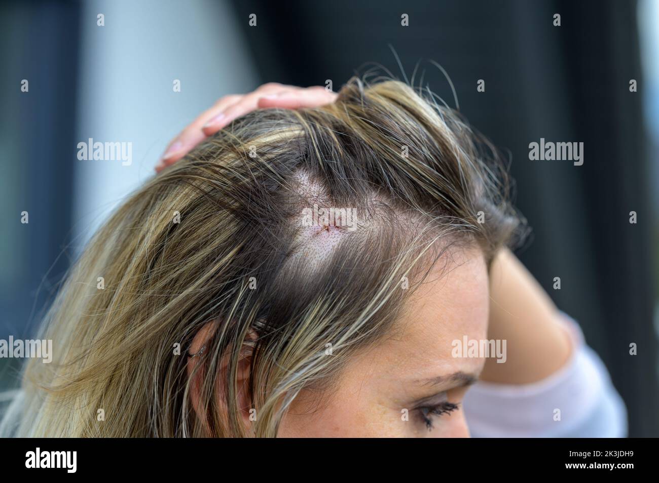 A close-up of the head and eye of a blond woman with a recent surgery ...