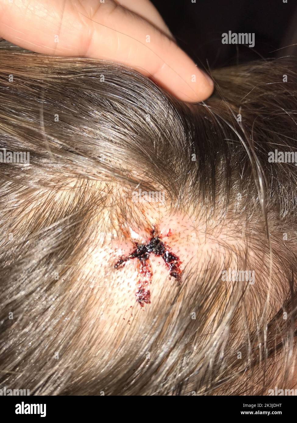 Close-up of a woman's bleeding head wound Stock Photo - Alamy