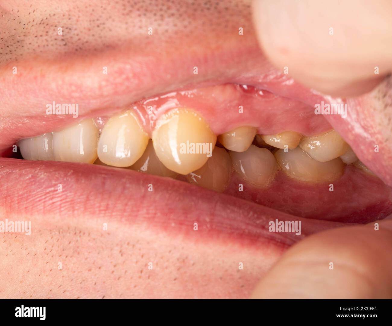 Ground prepared teeth before installing a porcelain fused-to-metal ...
