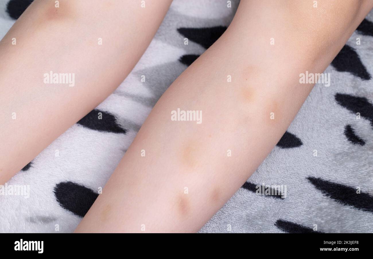 Spots, bruises on the legs of a child. The concept of injuries, lack of ...