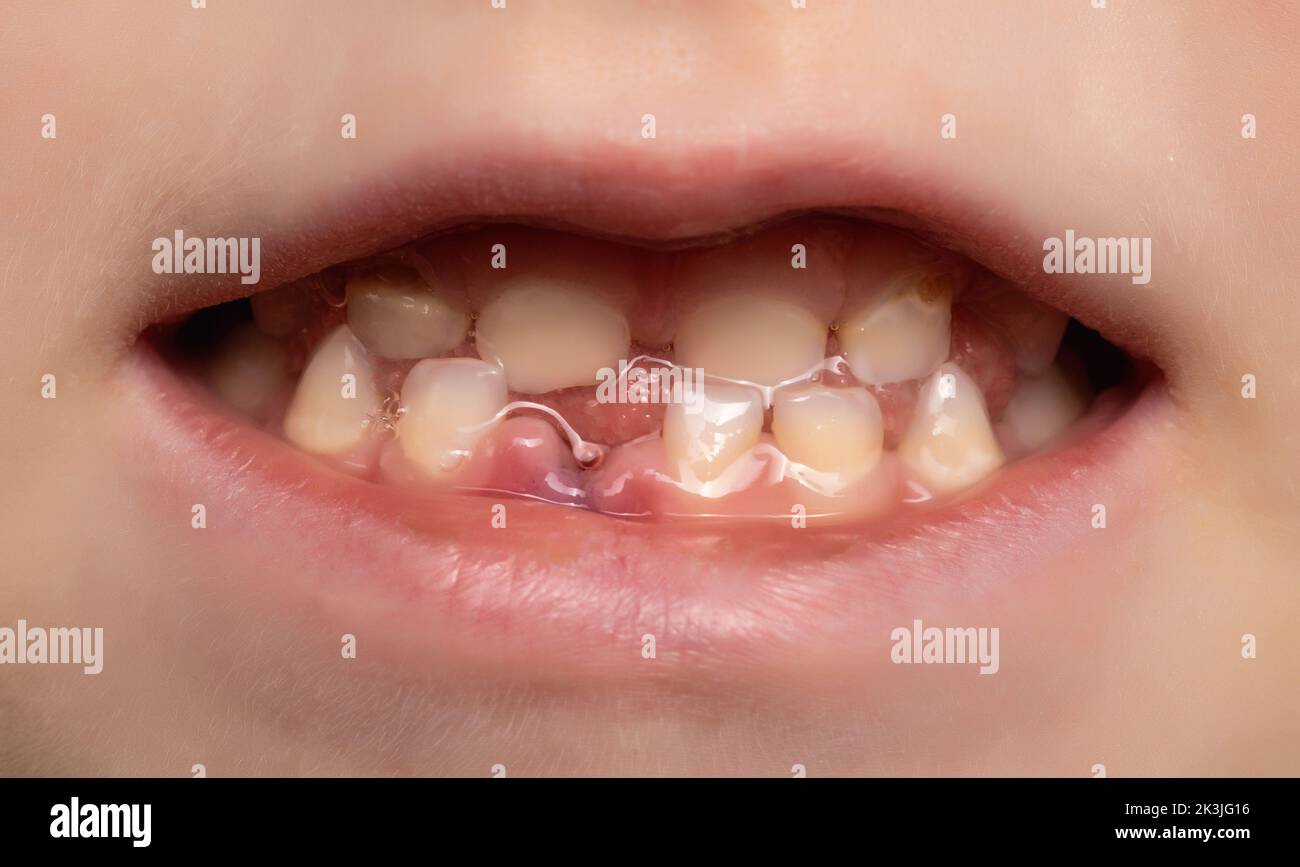 Beautiful smile of a child without one tooth. Change of milk teeth ...