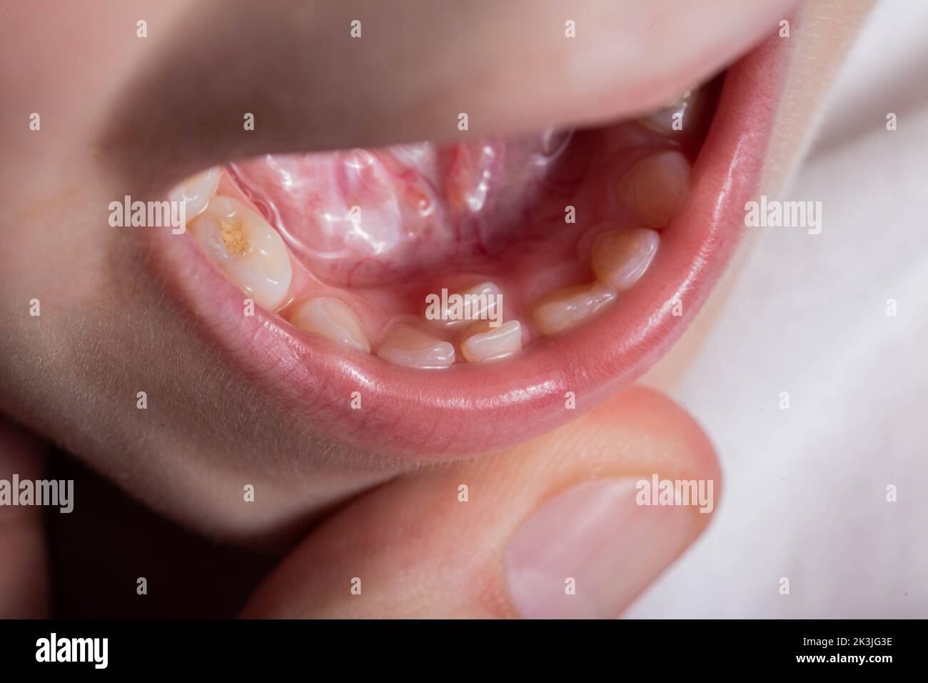 A permanent molar in a child grows second row. Incorrect growth of ...