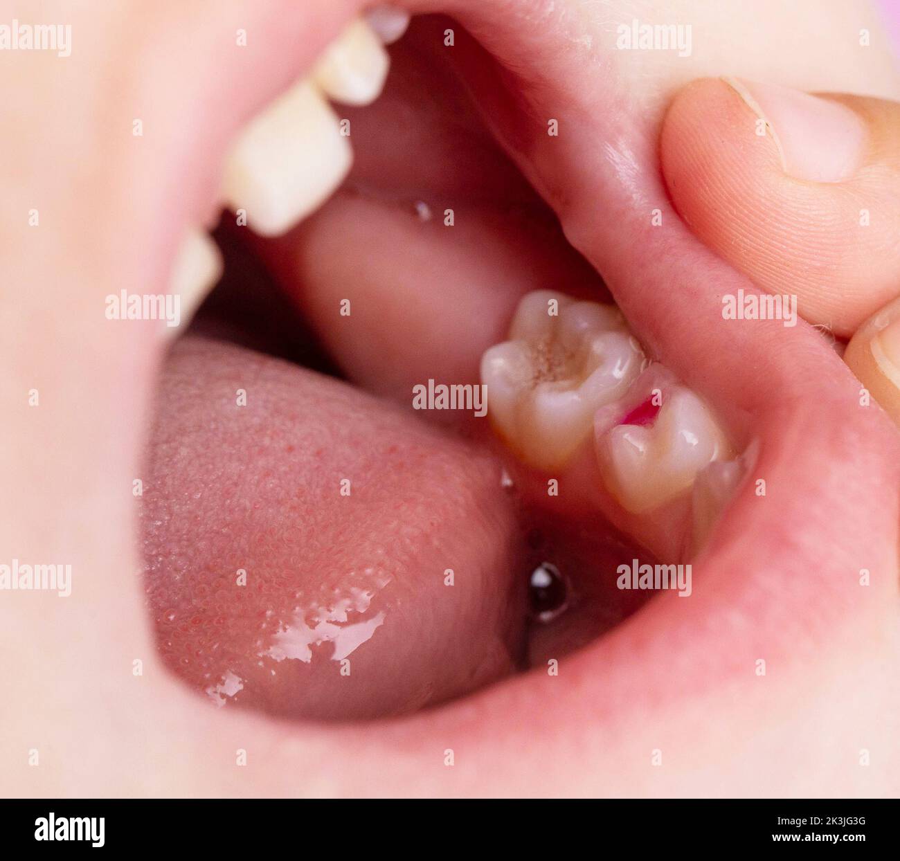 Installation of a colored red filling in a milk tooth for a child ...