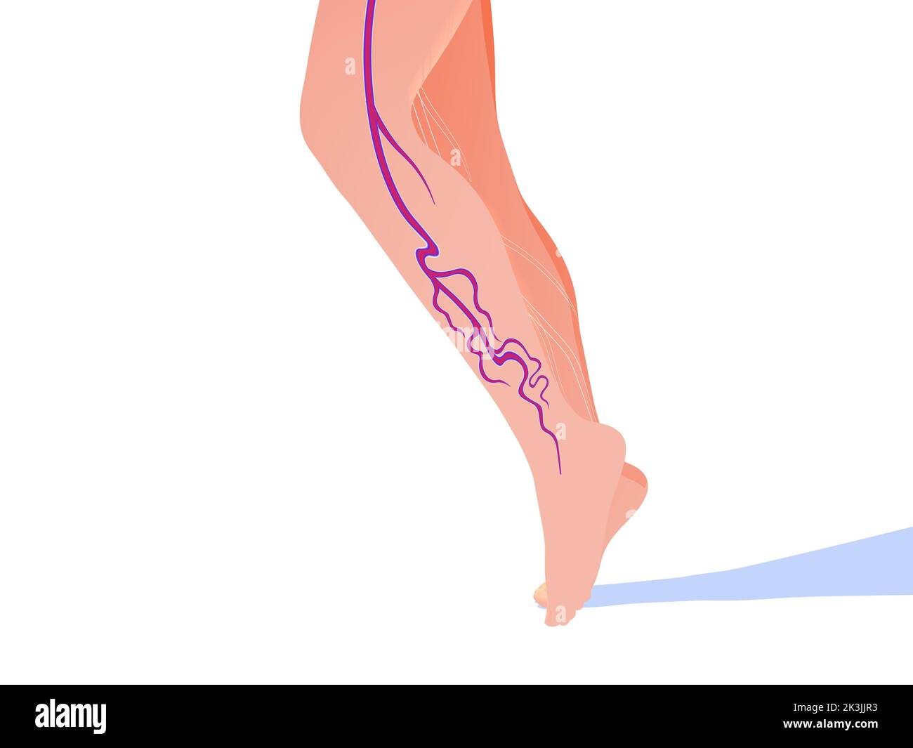 3d illustration of the venous system with varicose veins in one leg ...