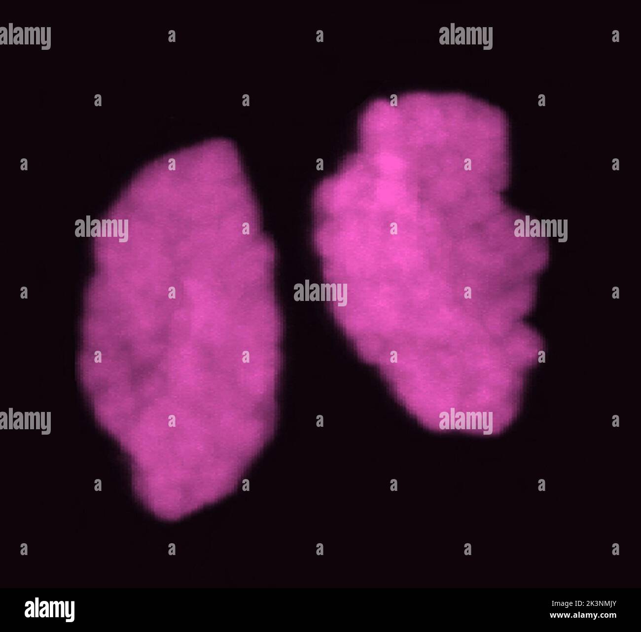 Human chromosomes in telophase, light micrograph Stock Photo - Alamy