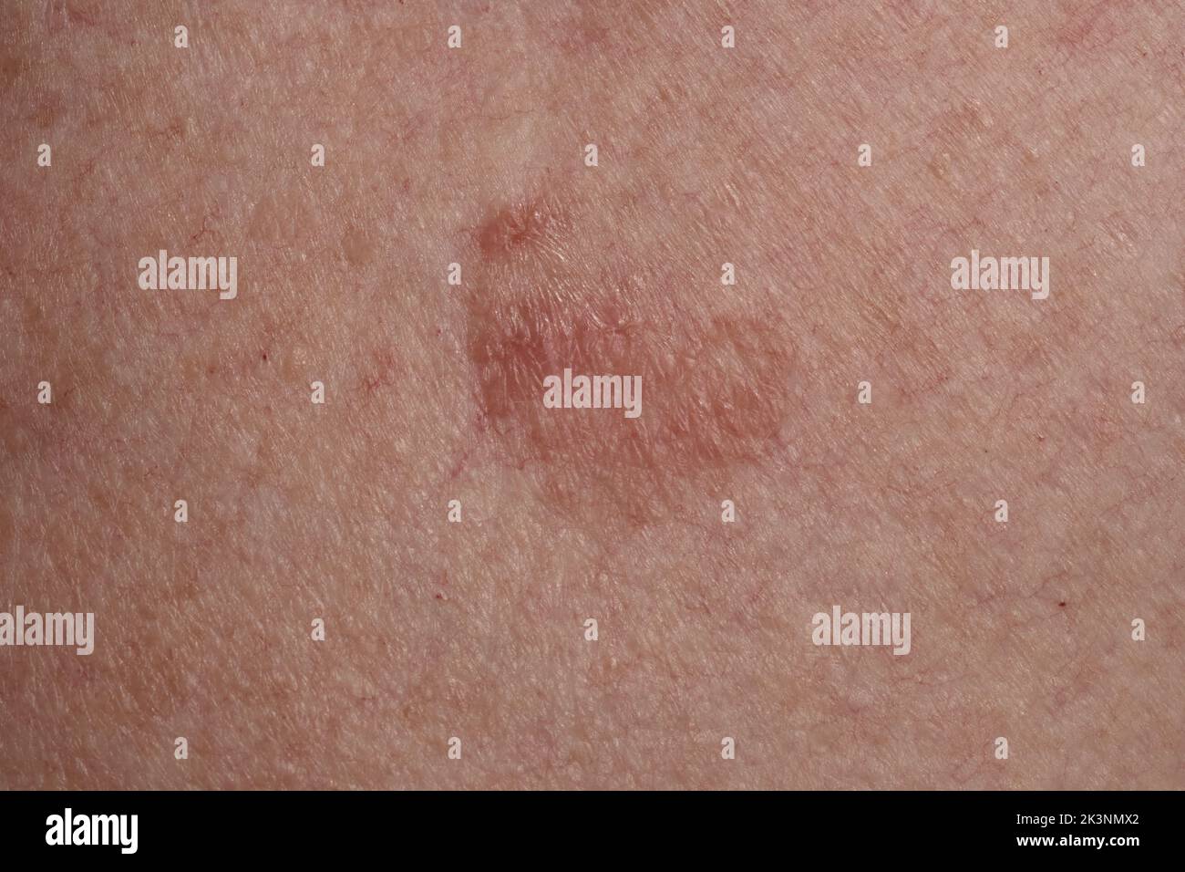 Basal cell carcinoma Stock Photo - Alamy