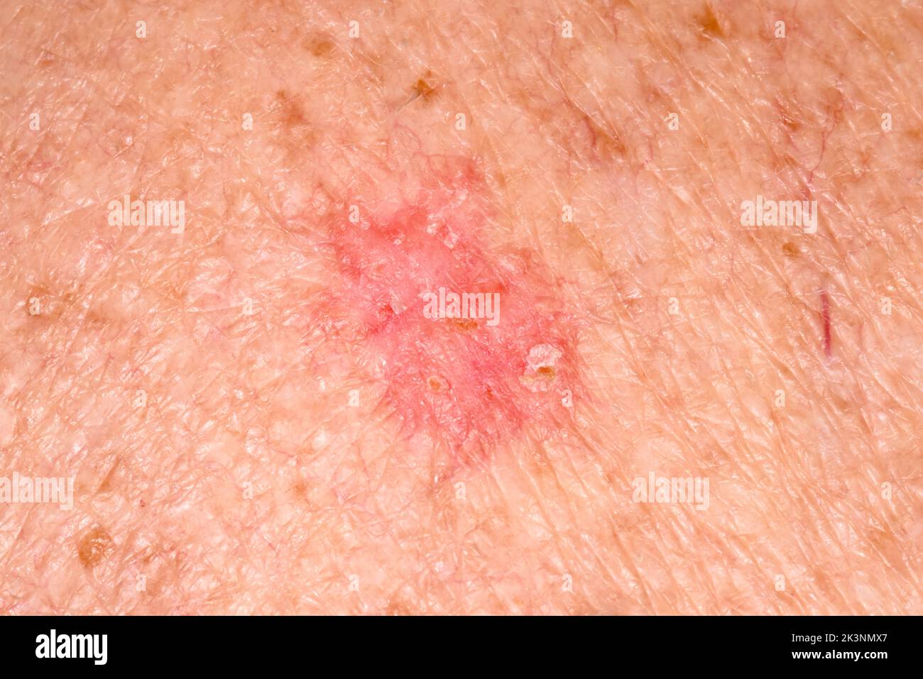 Basal cell carcinoma Stock Photo - Alamy