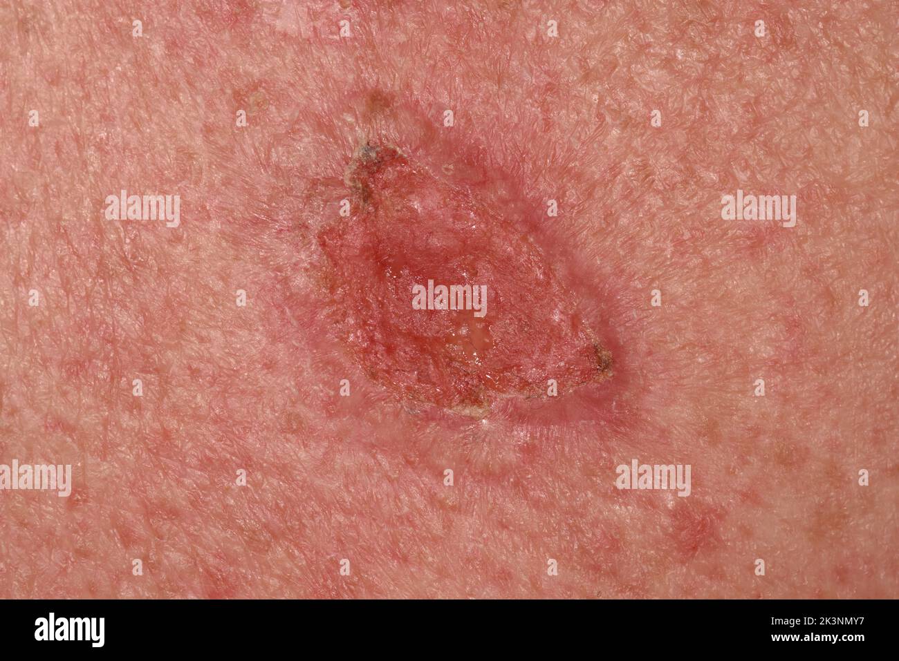 Basal cell carcinoma Stock Photo - Alamy