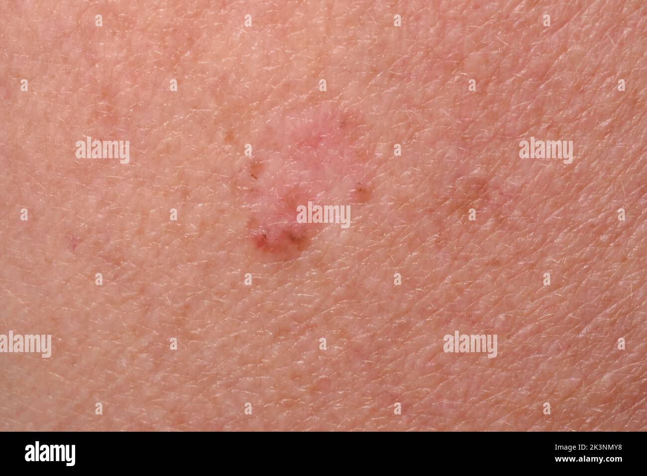 Superficial basal cell carcinoma Stock Photo - Alamy