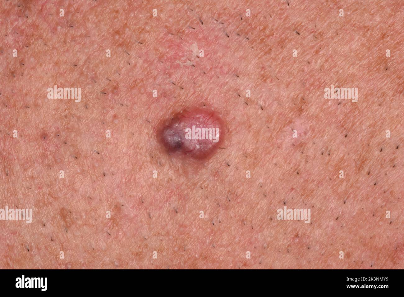 Basal cell carcinoma Stock Photo - Alamy