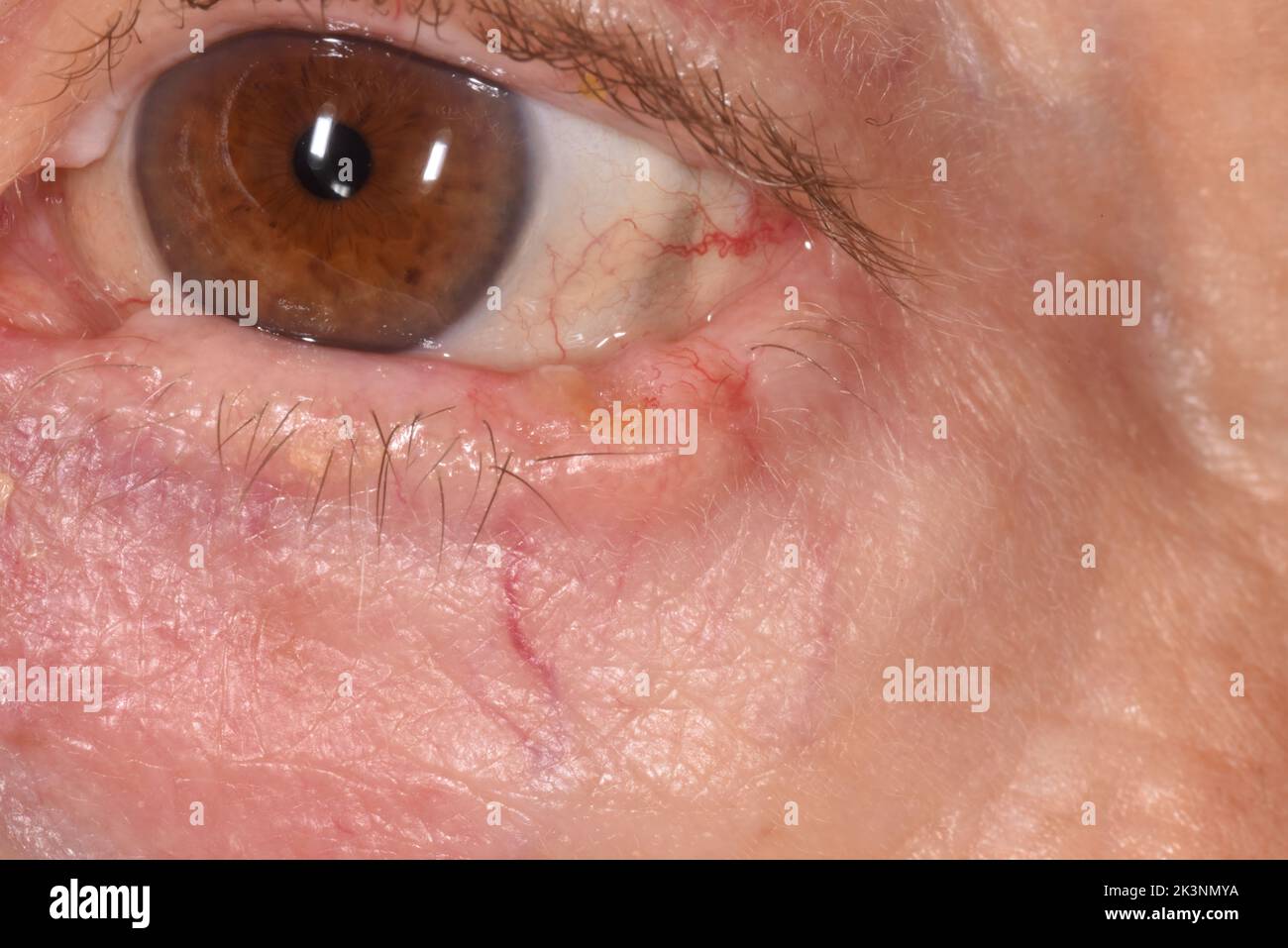 Basal cell carcinoma Stock Photo - Alamy