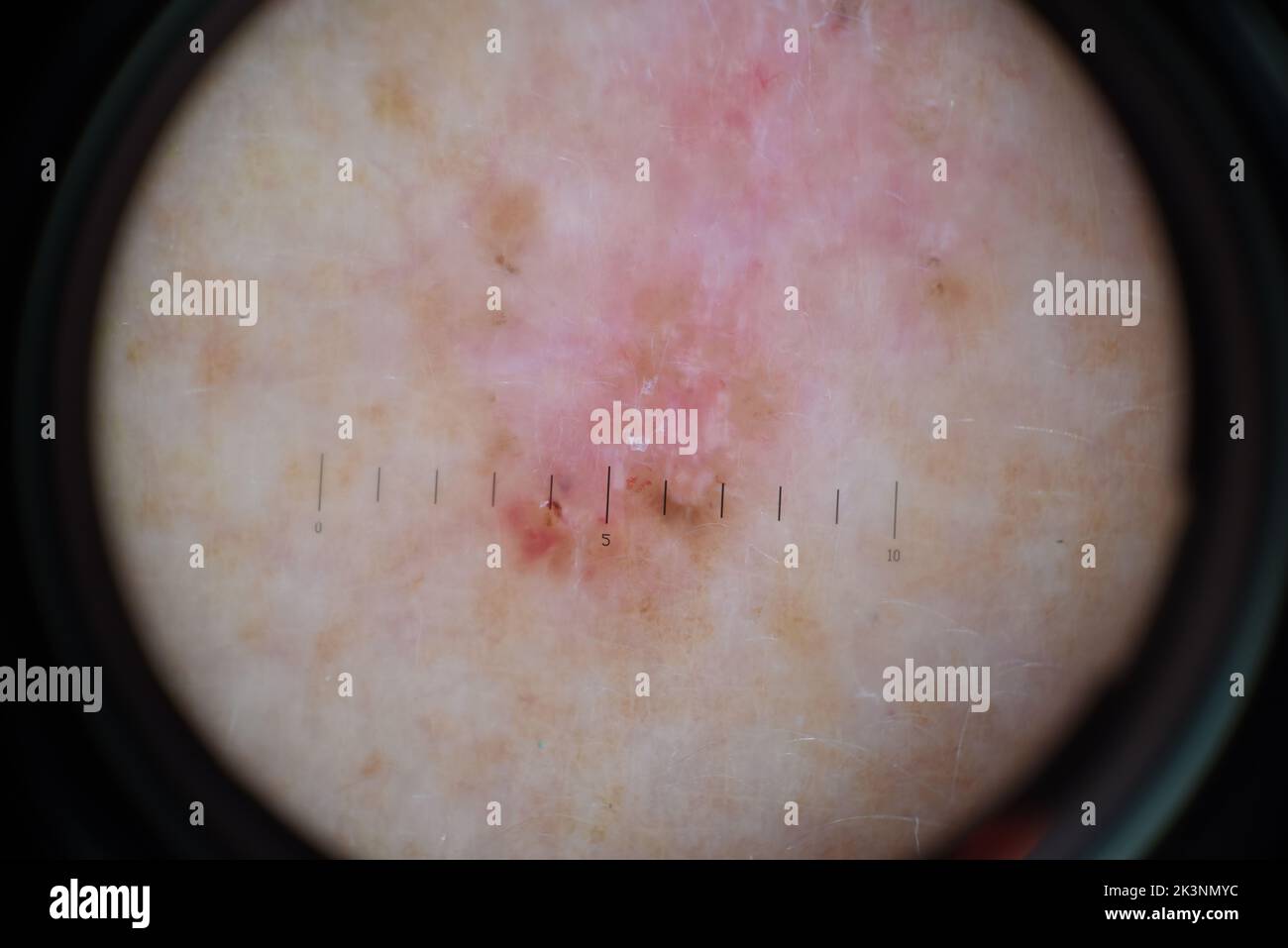 Basal cell carcinoma, dermatoscope image Stock Photo - Alamy