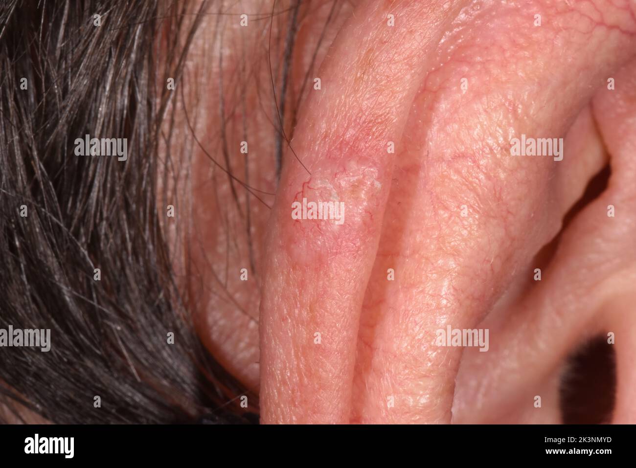 Basal cell carcinoma Stock Photo - Alamy