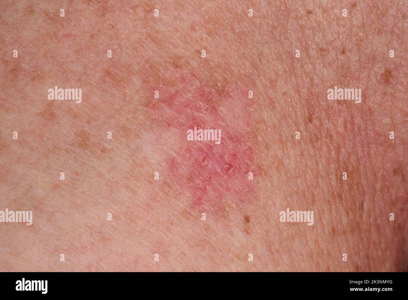 Basal cell carcinoma Stock Photo - Alamy