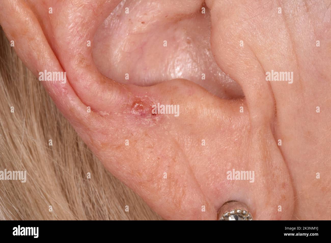 Basal cell carcinoma Stock Photo - Alamy