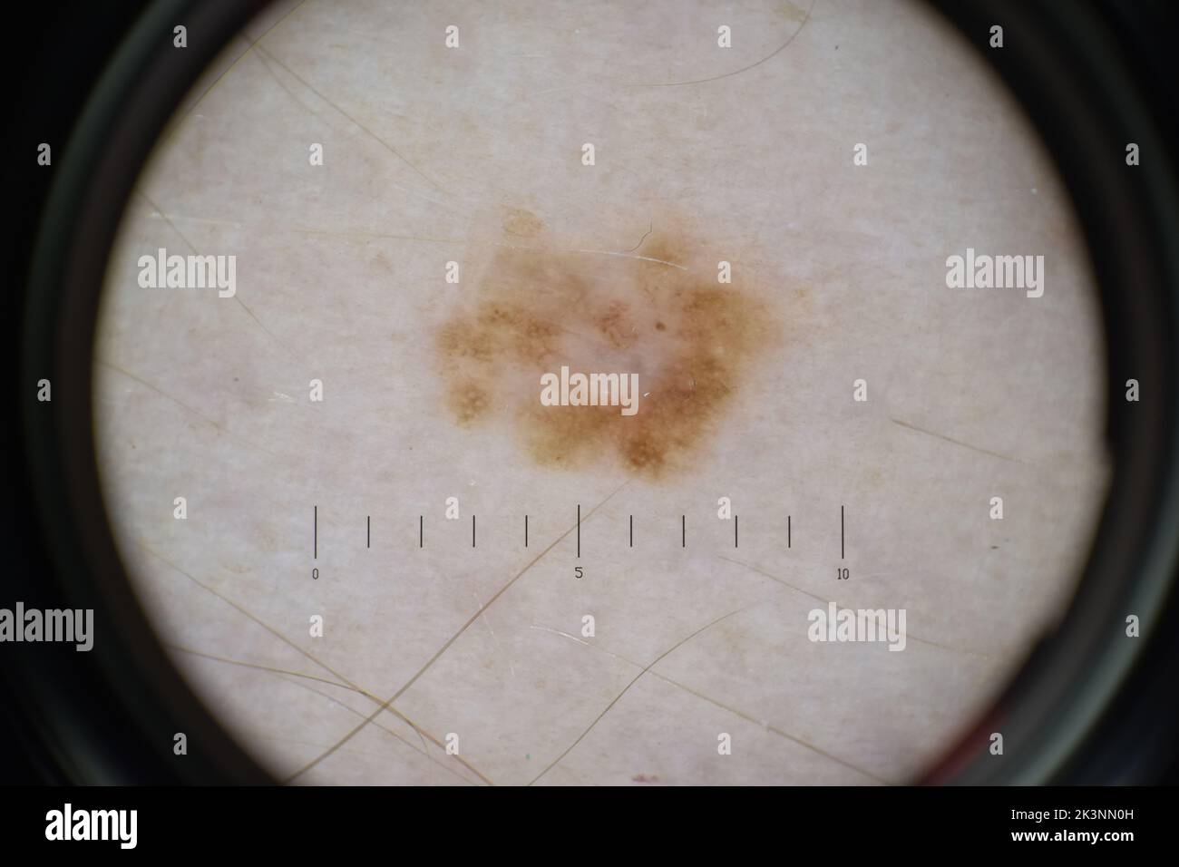 Melanoma in situ, dermatoscope image Stock Photo - Alamy