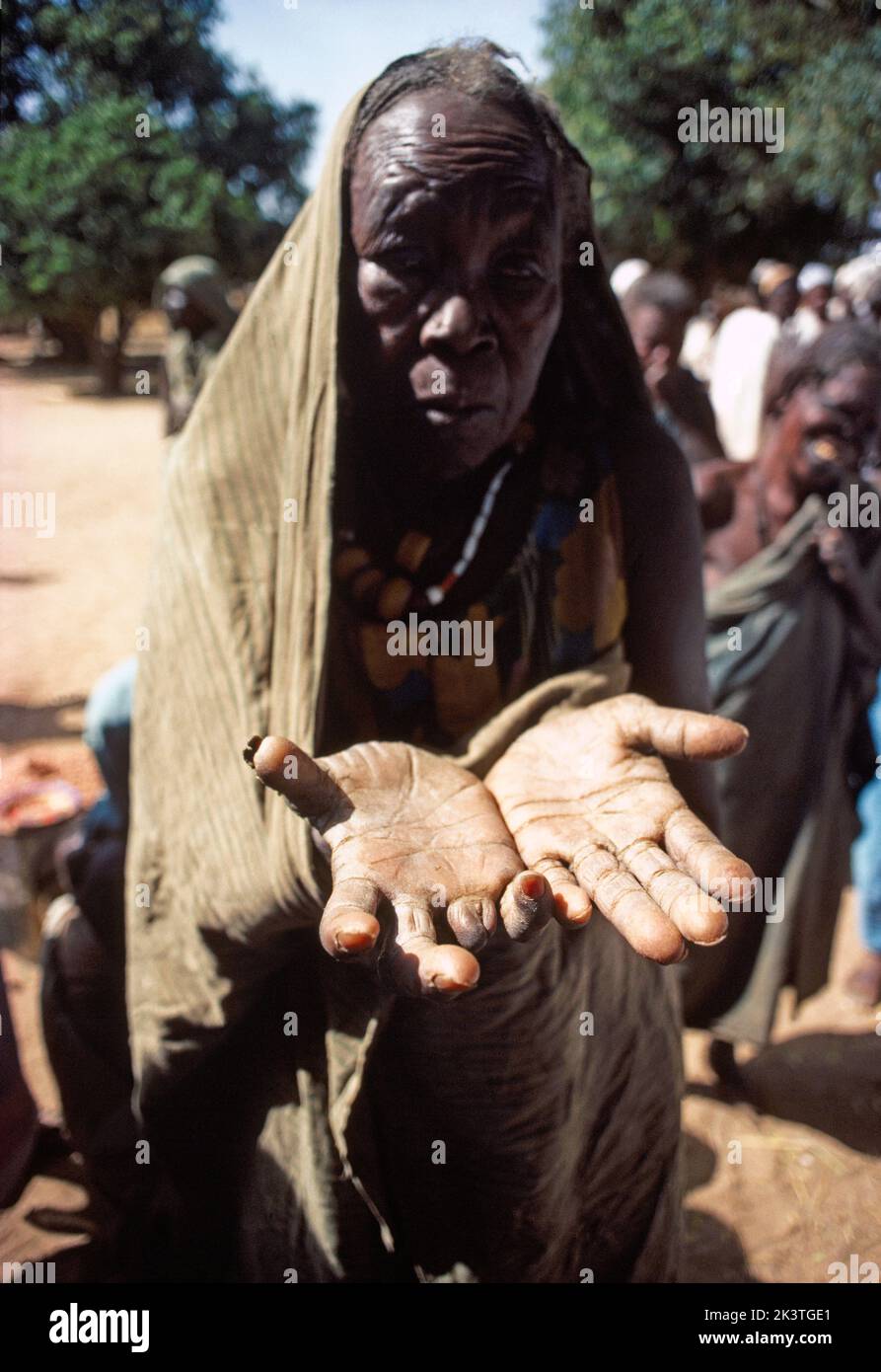 El Geneina Sudan Leprosy Victim Showing Loss of Fingers Stock Photo - Alamy