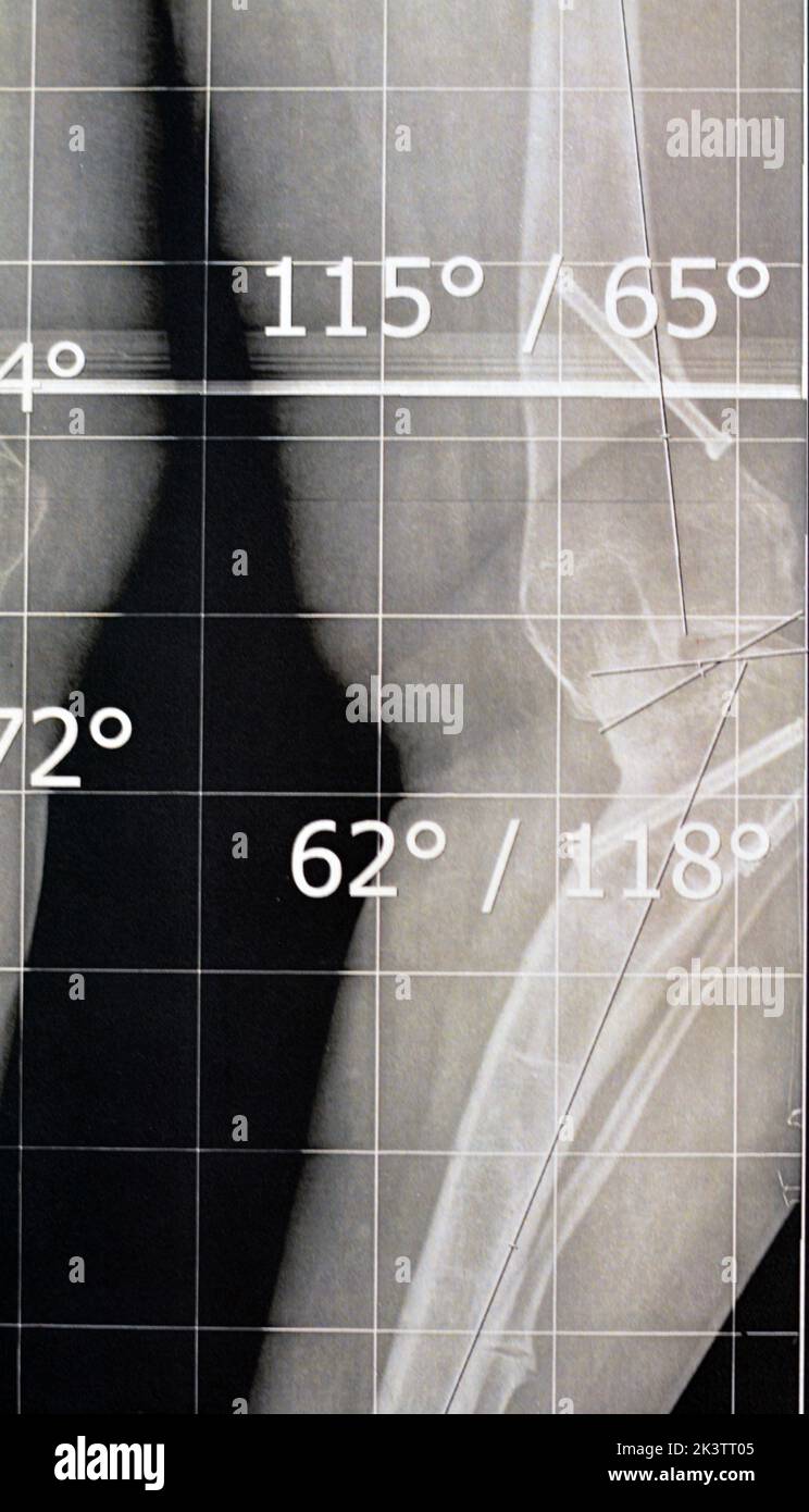 Plain x ray long film standing position showing both legs with ...