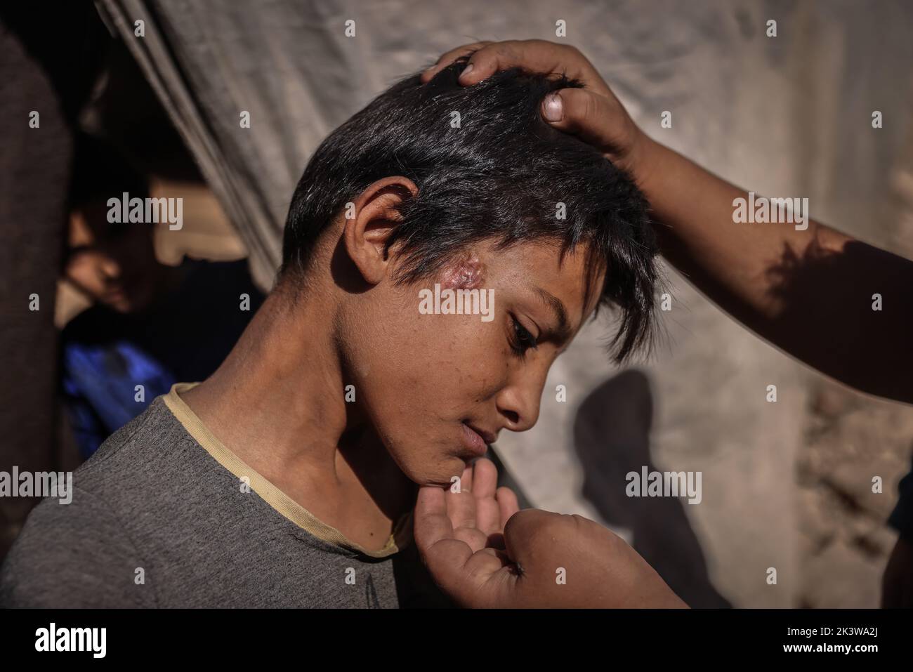 Skin lesions hi-res stock photography and images - Alamy