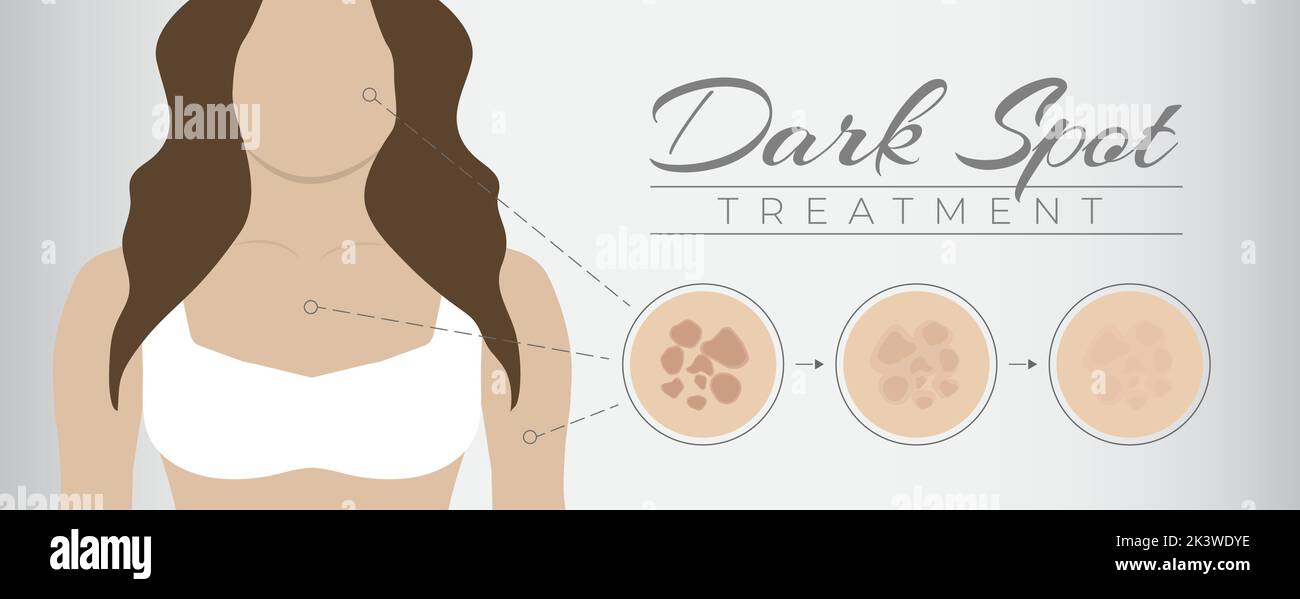 Dark Spot Treatment Illustration Design with Woman and Melasma Skin ...