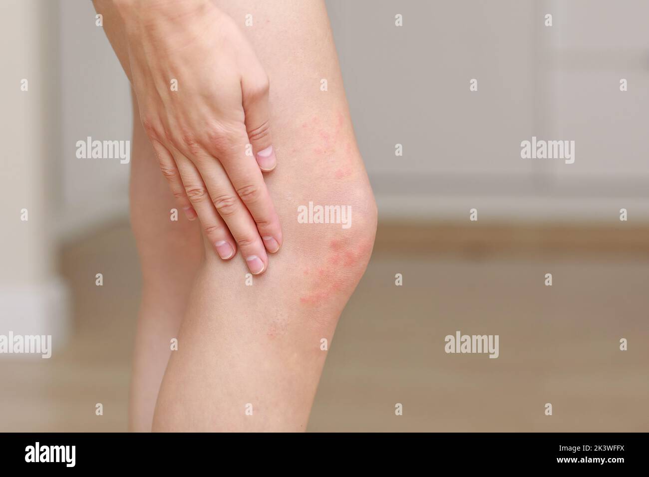 skin allergies, legs skin women. Closeup of red pustules on a knee, an ...