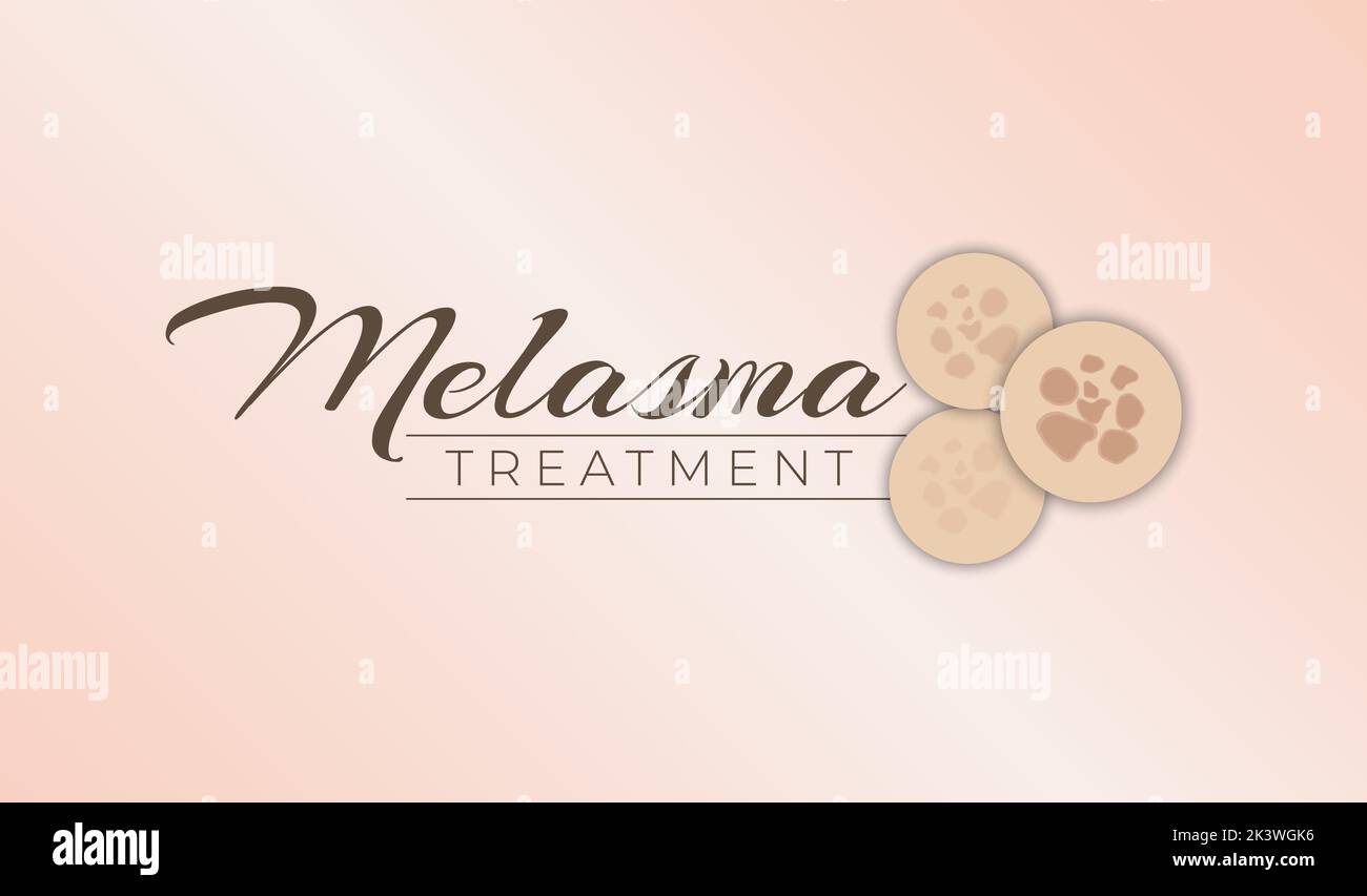 Melasma Treatment Banner Background Vector Design Stock Vector Image ...