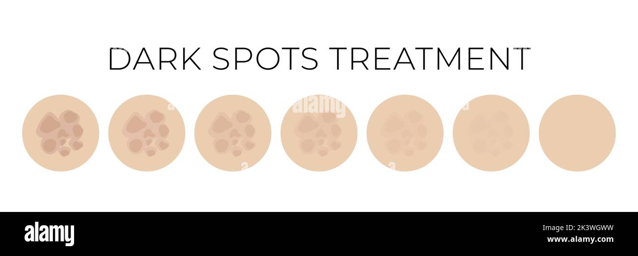 Dark Spots Treatment Isolated Illustration with Lightening or Fading ...