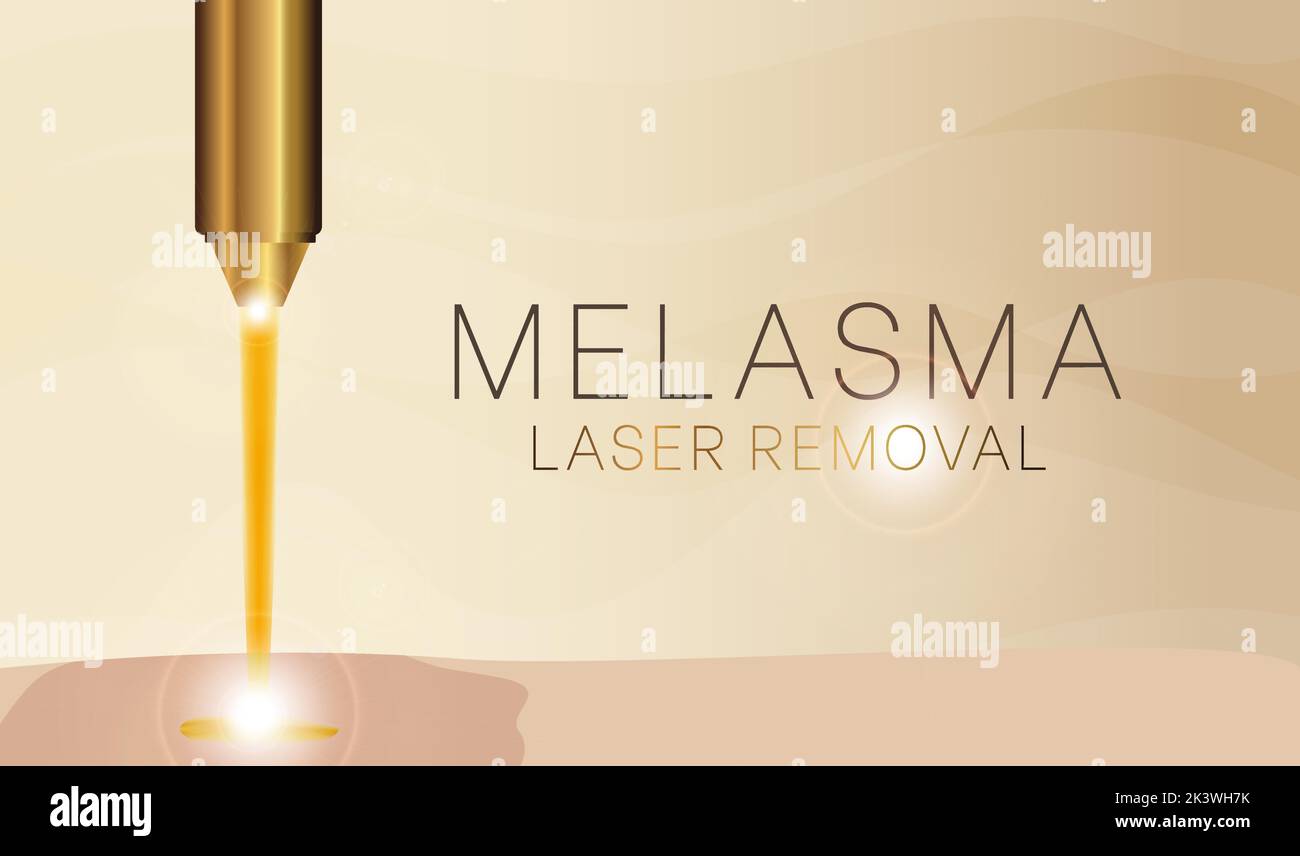 Melasma Laser Removal Background Illustration Stock Vector Image & Art ...