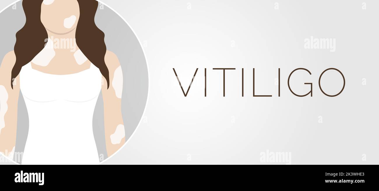 Melanin skin condition Stock Vector Images - Alamy