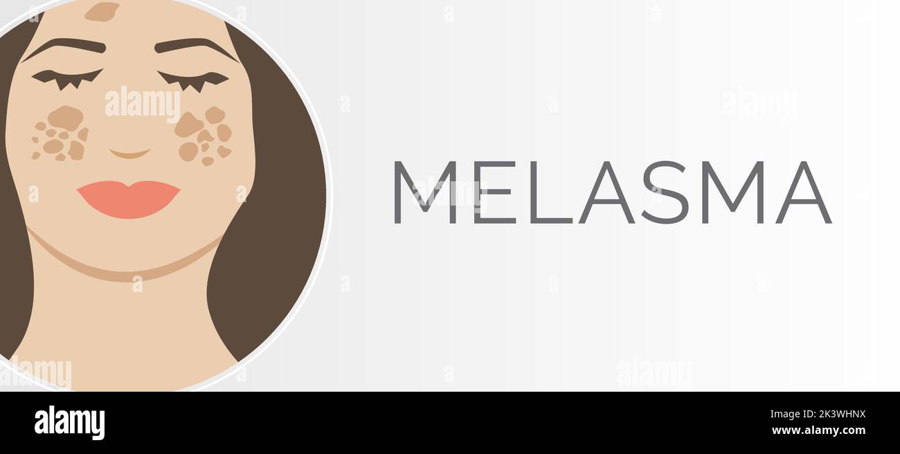 Melasma Skin Problem Background Illustration Design with Woman and Skin ...