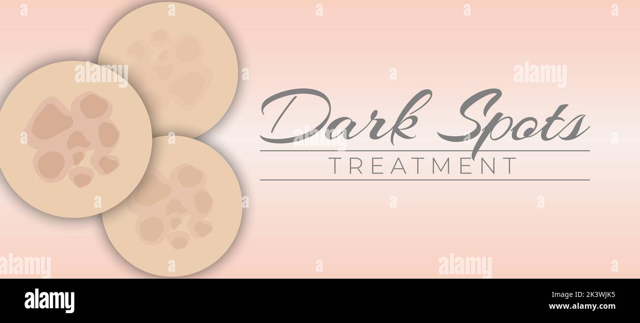 Dark Spots Fading Treatment Illustration Banner Background Stock Vector ...