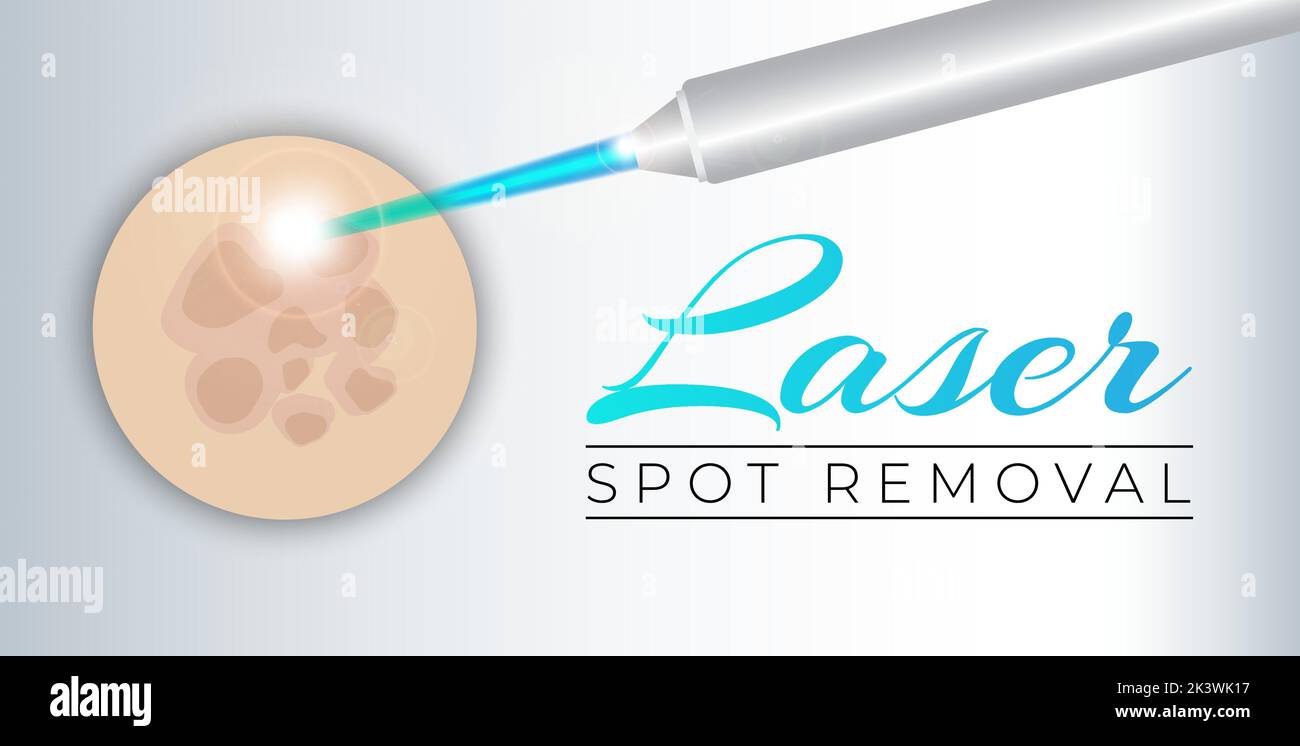 Laser Spot Removal Background Illustration Stock Vector Image & Art - Alamy