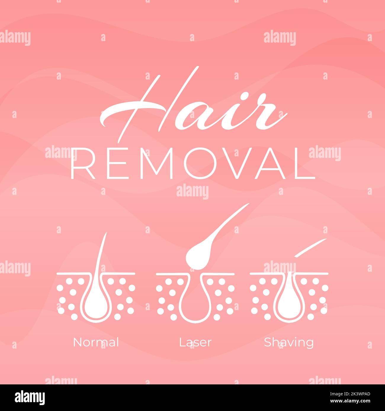 Pink Hair Removal with Normal Hair, Laser and Shaving Illustration ...