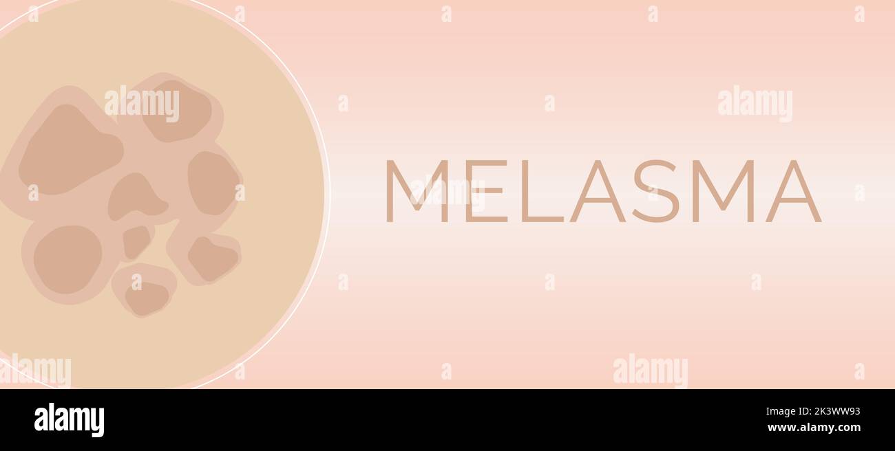 Melasma skin Stock Vector Images - Alamy