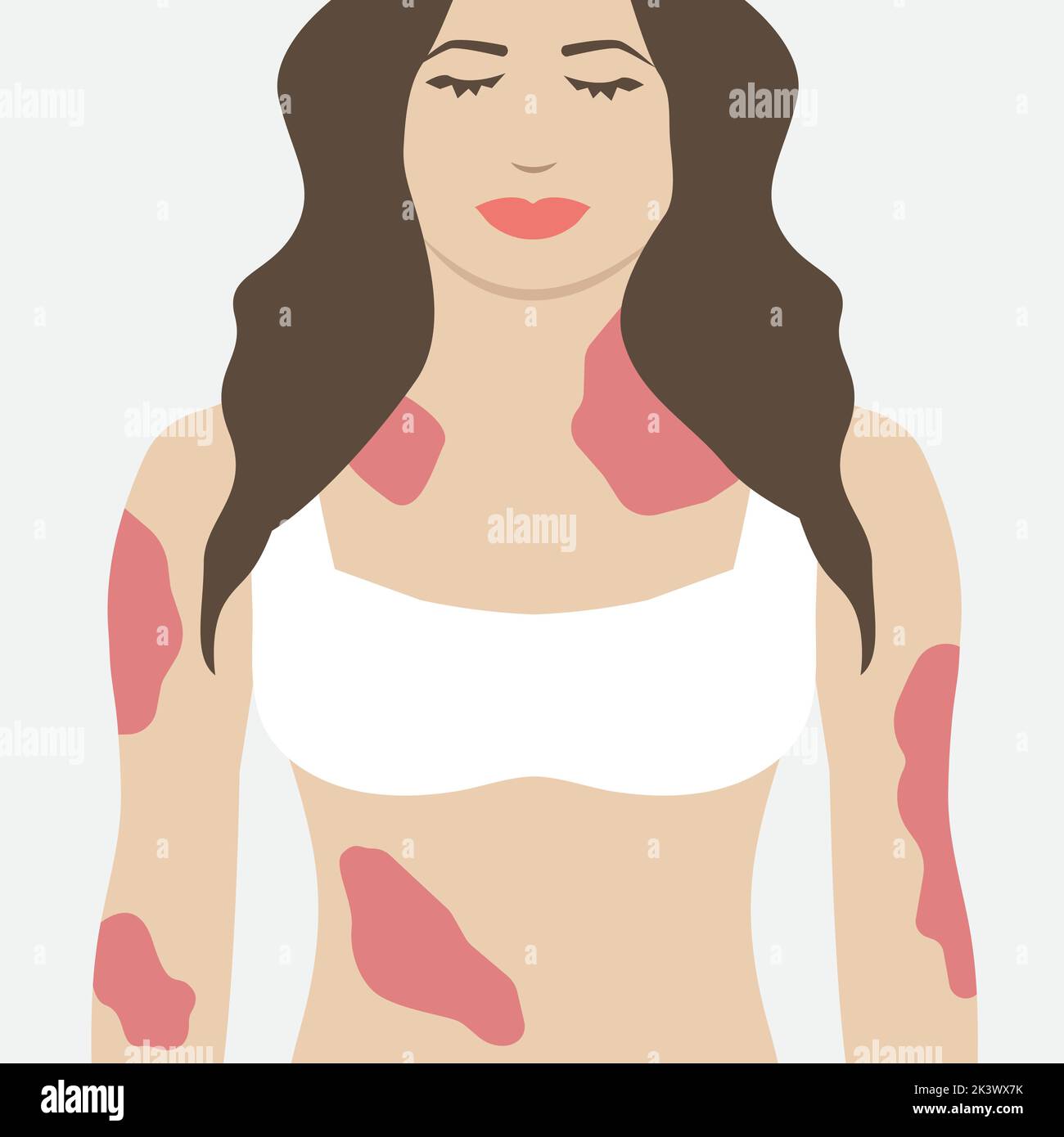 Psoriatic skin Stock Vector Images - Alamy